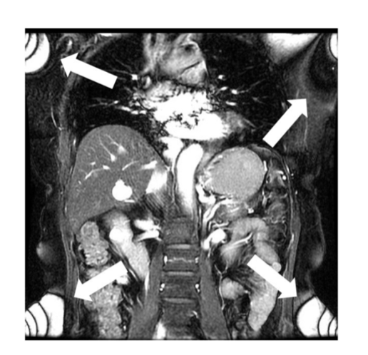 【MRI認定 24】SSFP、17問 | ラドライフ