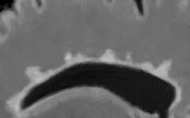 多発性硬化症(multiple sclerosis)[用語] | ラドライフ